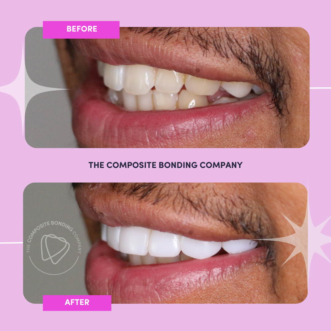 The Glow-Up You’ve Been Waiting For – Made by The Composite Bonding ...