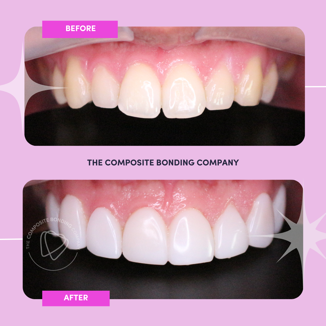 The Ultimate Guide to Composite Bonding in Oldham: Transform Your Smile ...