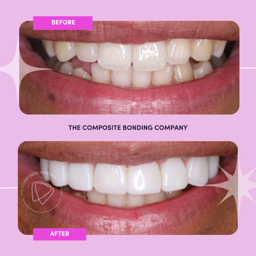 Composite Bonding in Oldham: 7 Beautiful Smile Benefits - The Composite ...